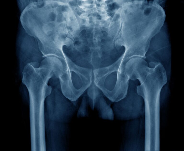 Artificial Joint Replacement Technology | Corentec