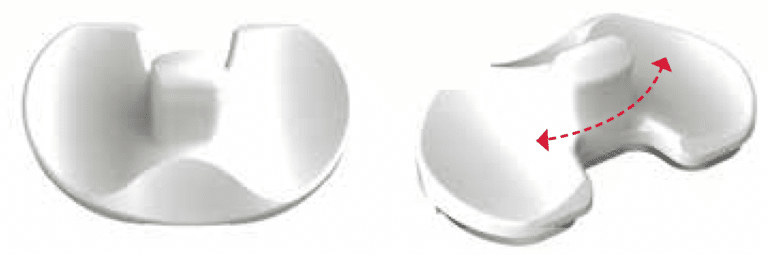 Exult Knee Replacement System | Corentec
